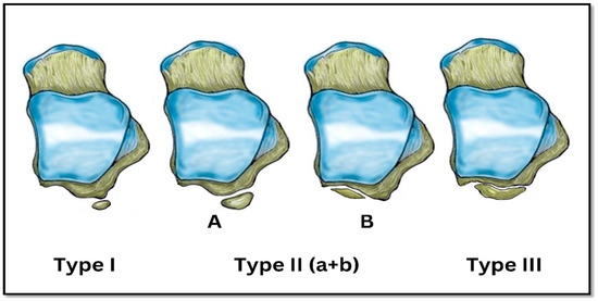 Computed Tomography Assessment of Os Trigonum in the Omani Population ...
