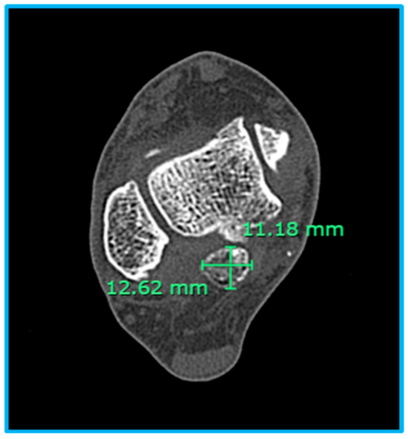 Computed Tomography Assessment of Os Trigonum in the Omani Population ...