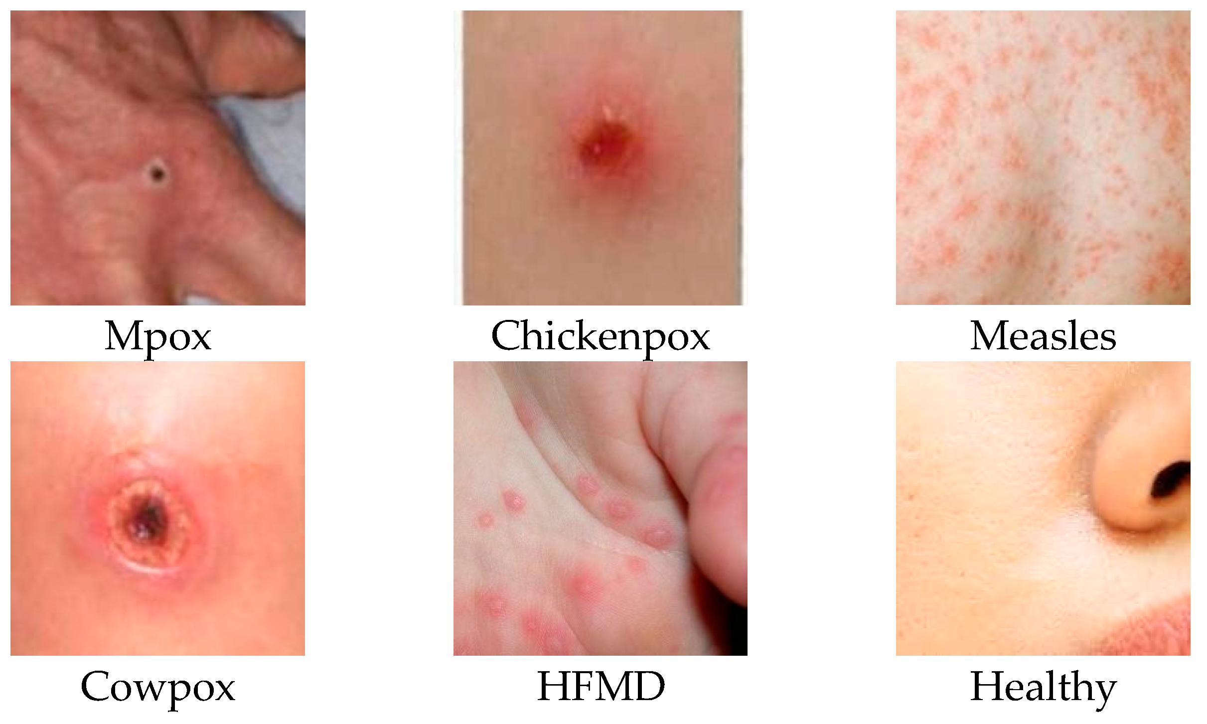 Multi-Classification of Skin Lesion Images Including Mpox Disease Using Transformer-Based Deep ...