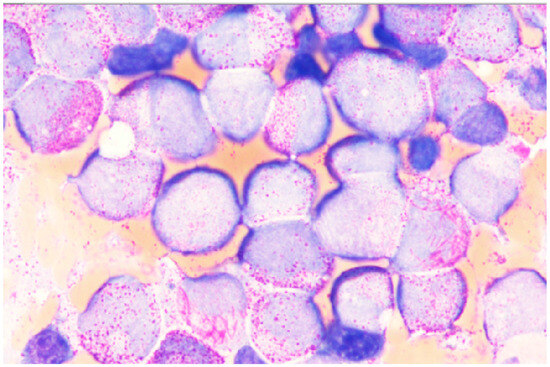 Hematopathological Patterns in Acute Myeloid Leukemia with ...