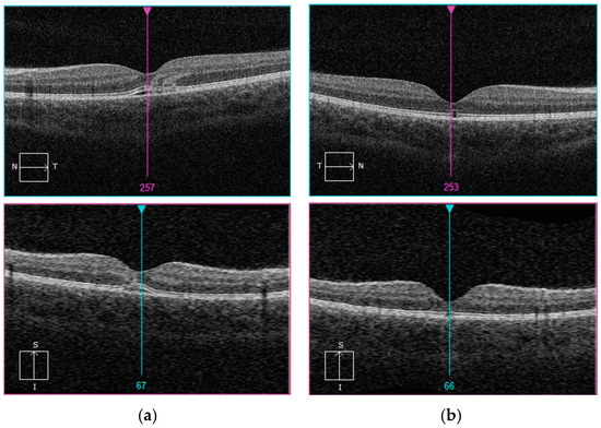 Bilateral Maculopathy After Self-Inflicted Laser Pointer Injury