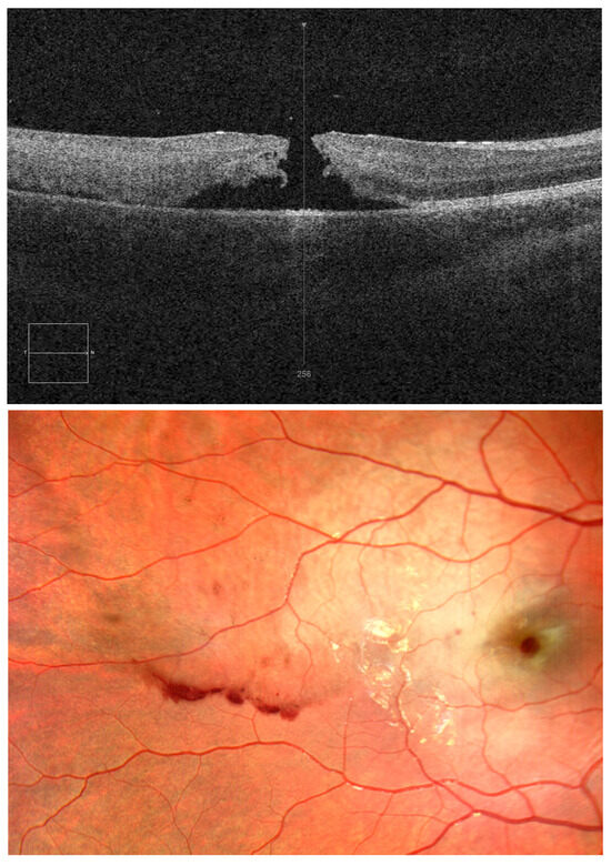Spontaneous Closure of a Full-Thickness Traumatic Macular Hole in a ...
