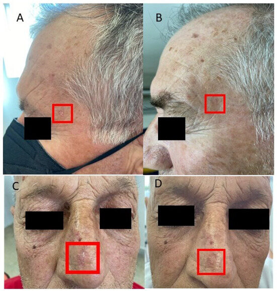 Response Rate to the Intervention with Tirbanibulin 1% Ointment for ...