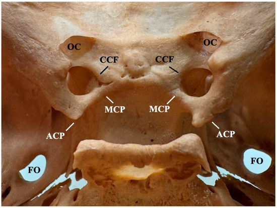 Prevalence and Morphology of Ossified Caroticoclinoid Ligament: An ...