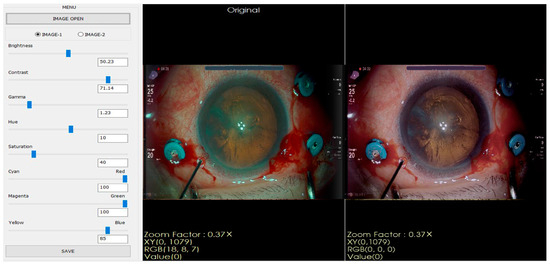 Automated Imaging of Cataract Surgery Using Artificial Intelligence