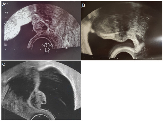Bladder Endometriosis: Diagnostic, Therapy, and Outcome of a Single ...