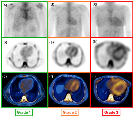 Future Directions in Quantitative SPECT-CT Evaluation of Cardiac ...