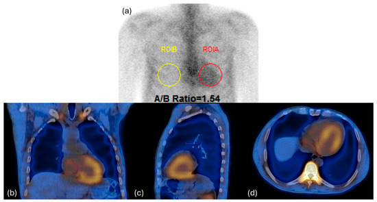 Future Directions in Quantitative SPECT-CT Evaluation of Cardiac ...