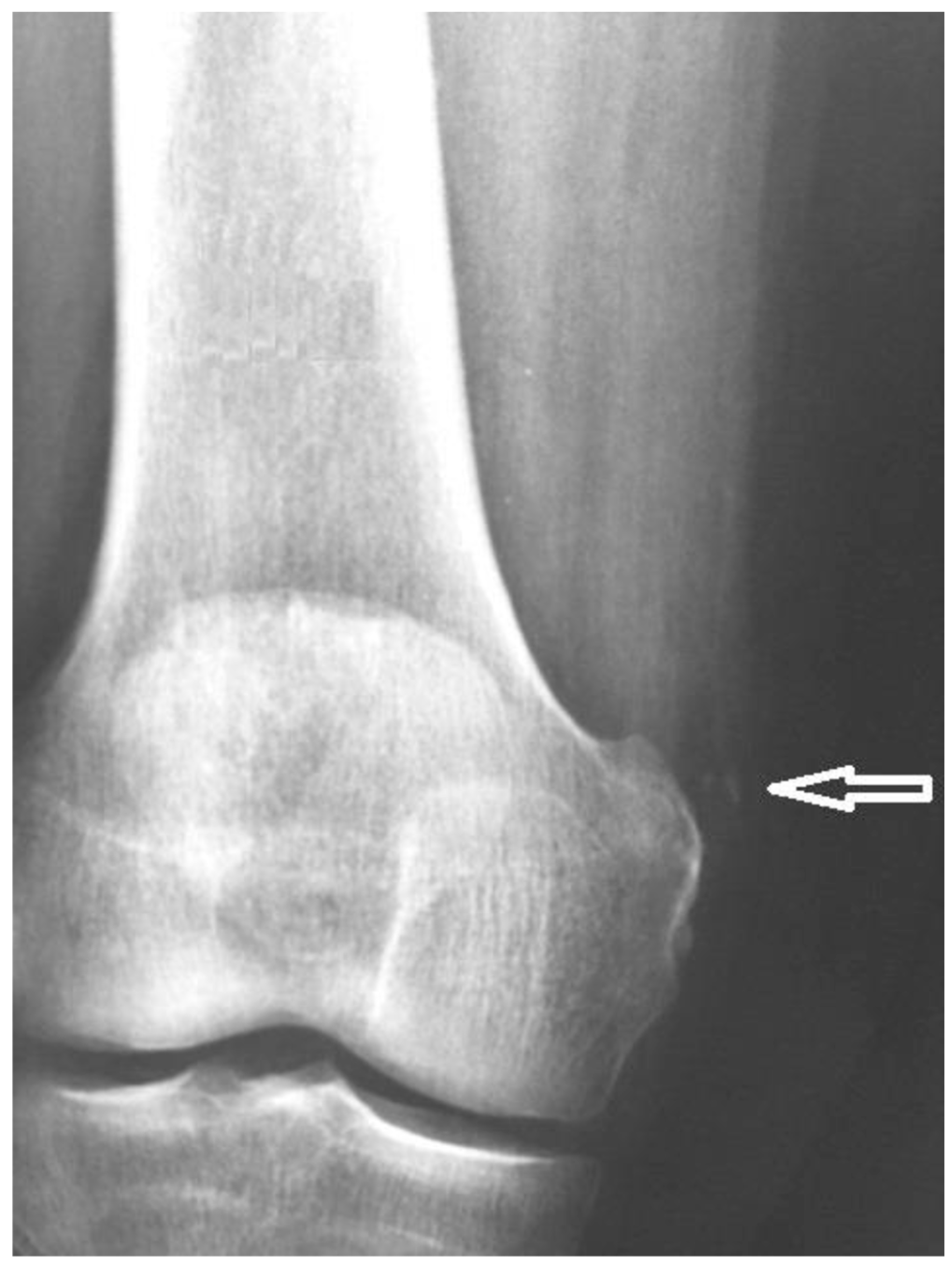 Calcifications of the Knee’s Medial Compartment: A Case Report and ...