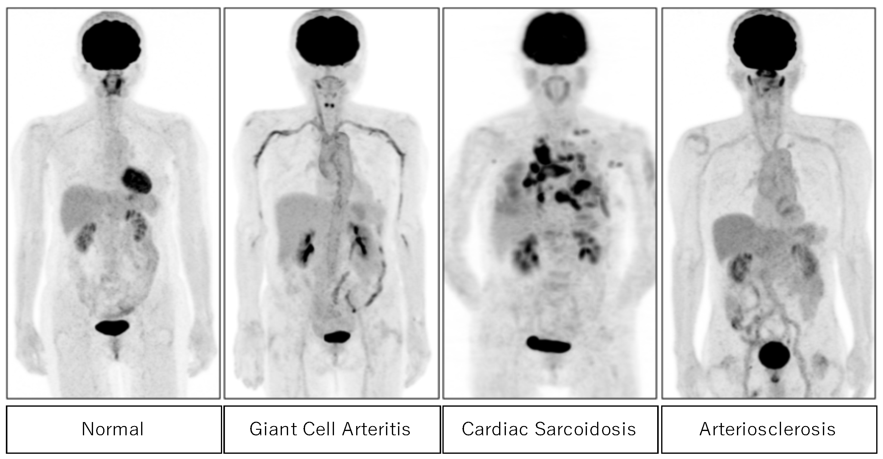 18F-Fluorodeoxyglucose Imaging for Assessing Cardiovascular Inflammation