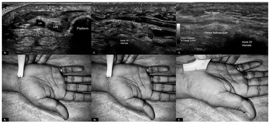 Unveiling Guyon’s Canal: Insights into Clinical Anatomy, Pathology, and ...