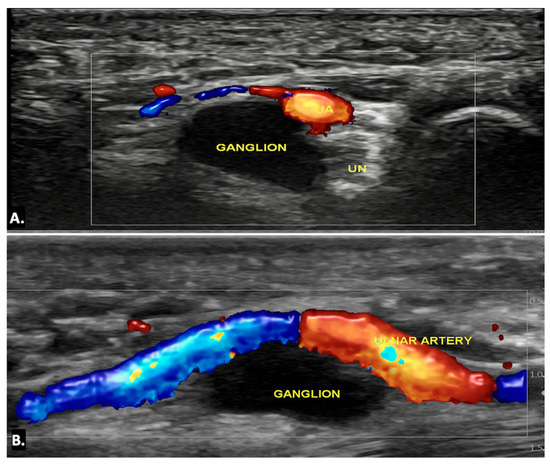Unveiling Guyon’s Canal: Insights into Clinical Anatomy, Pathology, and ...