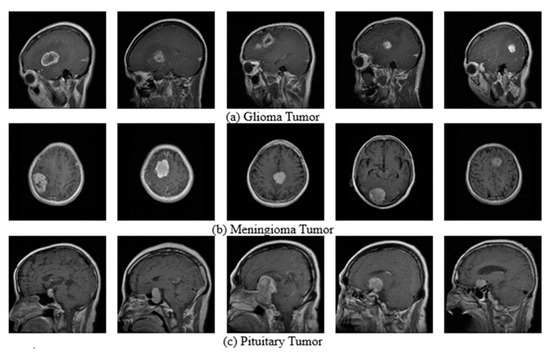 Learning Architecture for Brain Tumor Classification Based on Deep ...
