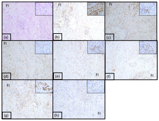 Immunohistochemical Evaluation of the Tumor Immune Microenvironment in ...