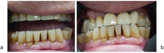 Oral Clinical and Radiological Signs of Excessive Occlusal Forces in ...