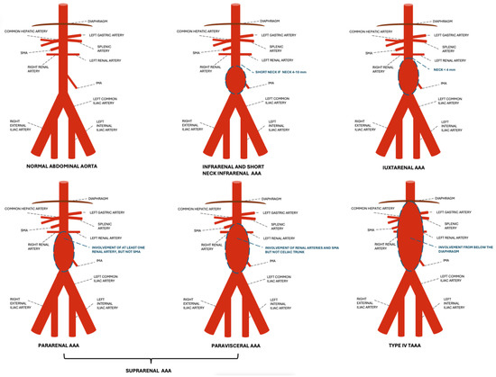 Atherosclerotic Abdominal Aortic Aneurysms on Computed Tomography ...