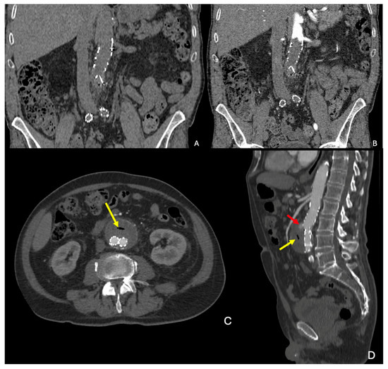 Atherosclerotic Abdominal Aortic Aneurysms on Computed Tomography ...