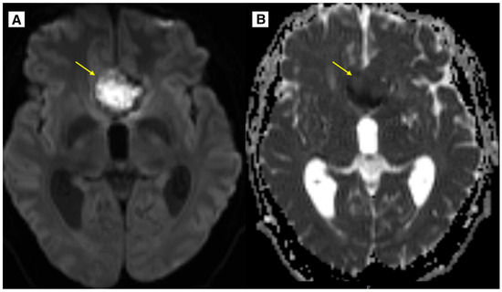 Ruptured Intracranial Dermoid Cyst with Fat Dissemination: A Clinical ...