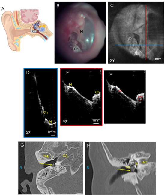 Optical Coherence Tomography Imaging and Angiography of Skull Base ...