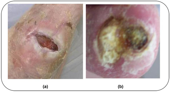 Diabetic Foot Ulcers Detection Model Using a Hybrid Convolutional ...