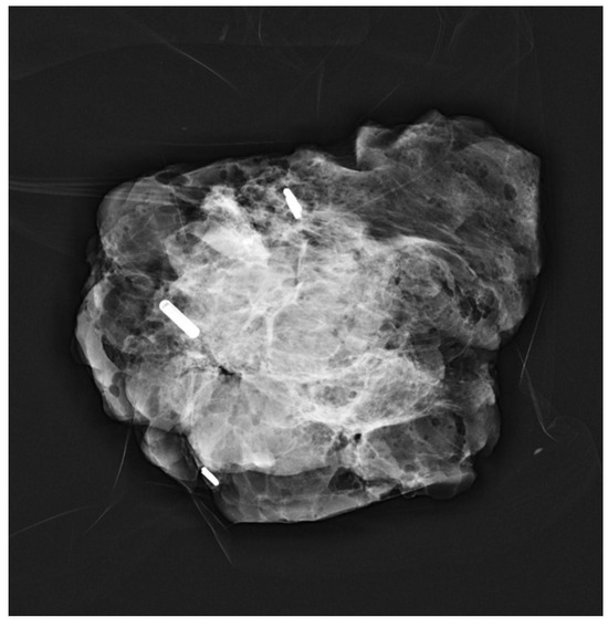 Evaluation of Hologic LOCalizer™ RFID Tags for Preoperative ...