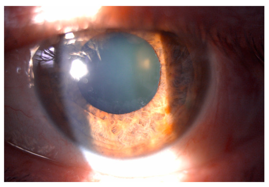 Unilateral Reverse Pupillary Block Associated with Multiple Ciliary ...