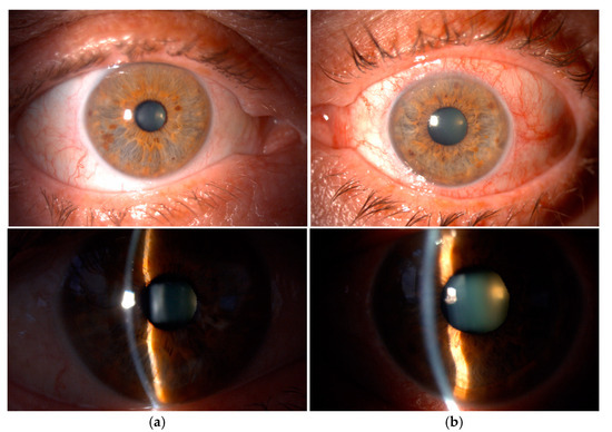 Unilateral Reverse Pupillary Block Associated with Multiple Ciliary ...