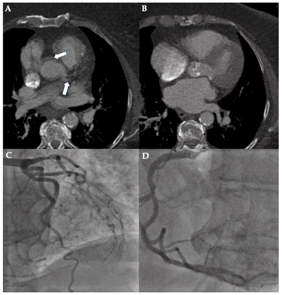 Predictors of Diagnostic Inaccuracy of Detecting Coronary Artery ...