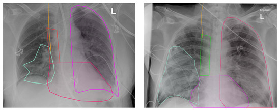 Impact of Radiologist Experience on AI Annotation Quality in Chest ...