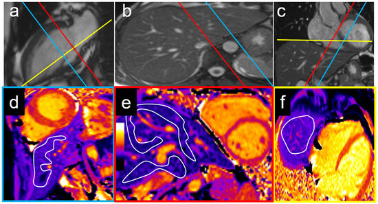 The Association of Heart Failure and Liver T1 Mapping in Cardiac ...