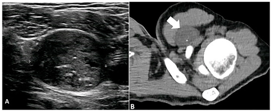 Pictorial Review of Soft Tissue Lesions with Calcification