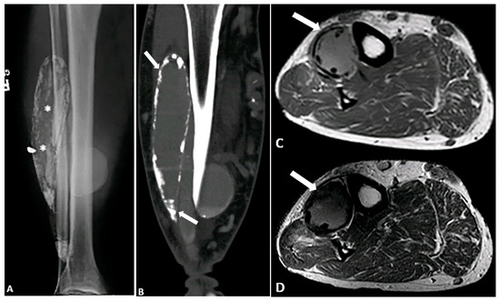 Pictorial Review of Soft Tissue Lesions with Calcification