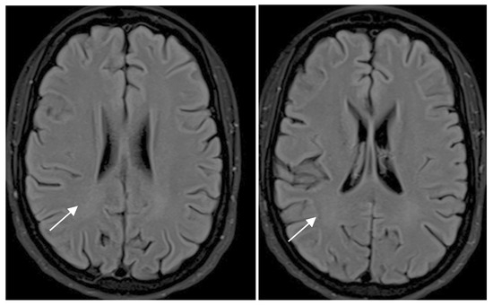 Assessment of Inter-Reader Reliability of Fazekas Scoring on Magnetic ...