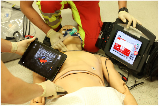 Point-of-Care Ultrasound Pulse Checks During Cardiopulmonary Resuscitation on a Patient ...