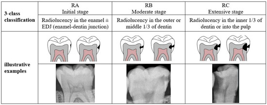 Automated Detection, Localization, and Severity Assessment of Proximal Dental Caries from ...