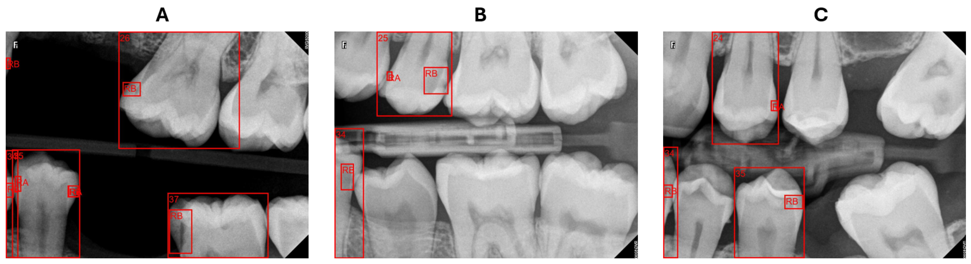 Automated Detection, Localization, and Severity Assessment of Proximal Dental Caries from ...