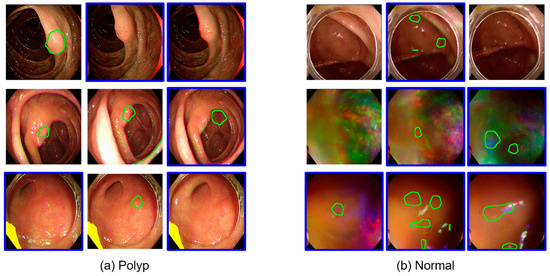 Real-World Colonoscopy Video Integration to Improve Artificial ...