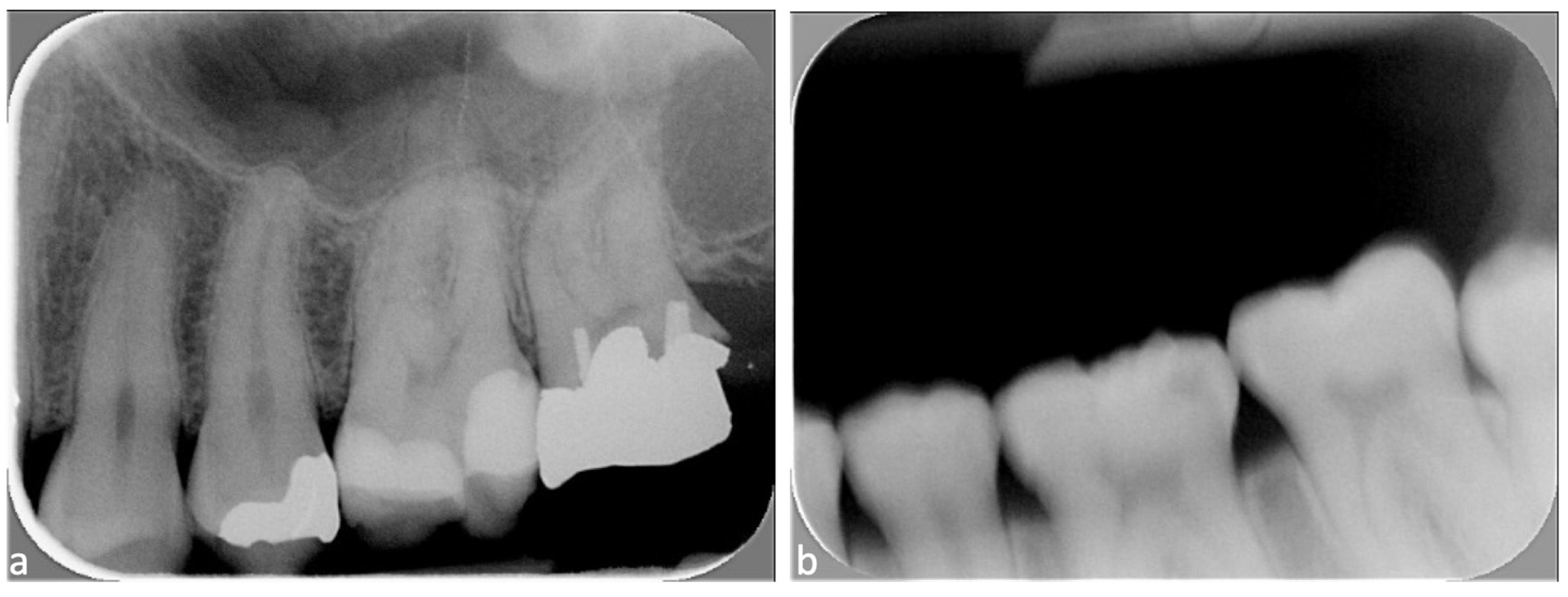 Impact of Rectangular Collimation on Quality of Intraoral Radiographs ...