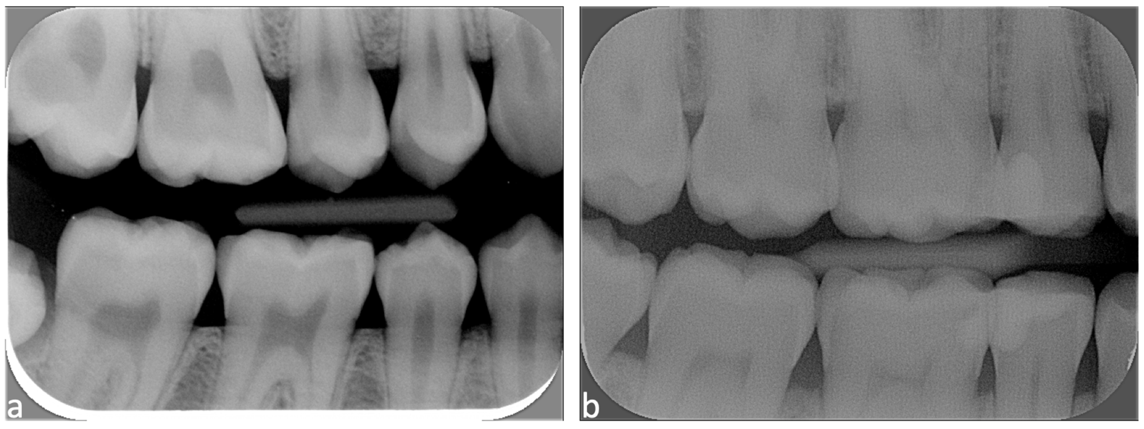 Impact of Rectangular Collimation on Quality of Intraoral Radiographs ...