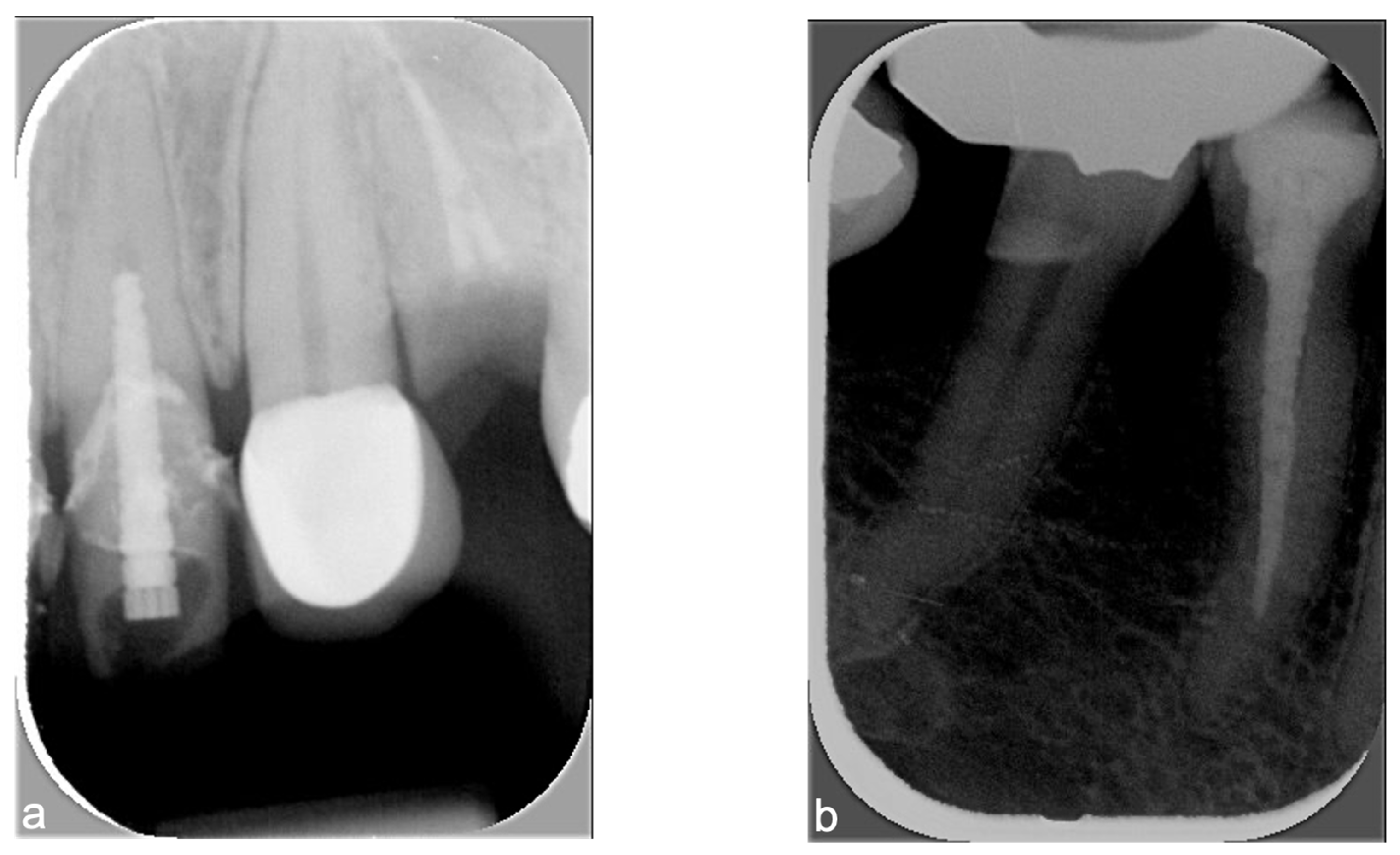 Impact of Rectangular Collimation on Quality of Intraoral Radiographs ...
