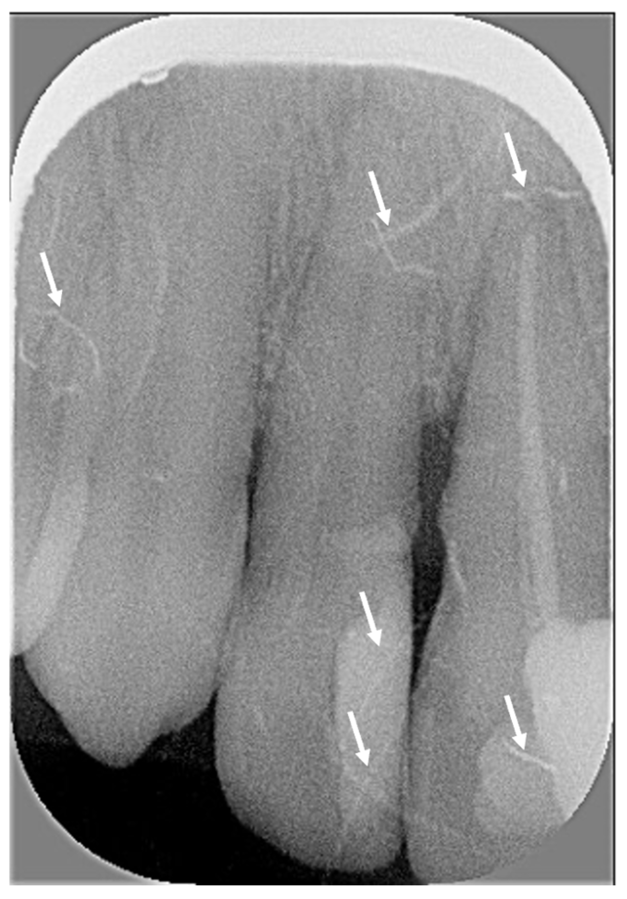 Impact of Rectangular Collimation on Quality of Intraoral Radiographs ...