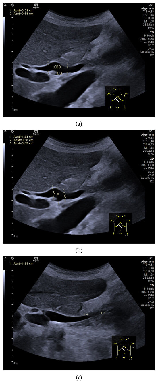 Ultrasound of Bile Ducts—An Update on Measurements, Reference Values, and Their Influencing Factors