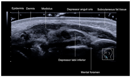 Best Practices for the Use of High-Frequency Ultrasound to Guide ...