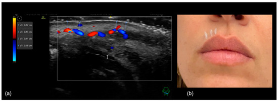 Best Practices for the Use of High-Frequency Ultrasound to Guide ...