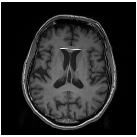 Magnetic Resonance Imaging in the Neuroimaging of Progressive ...