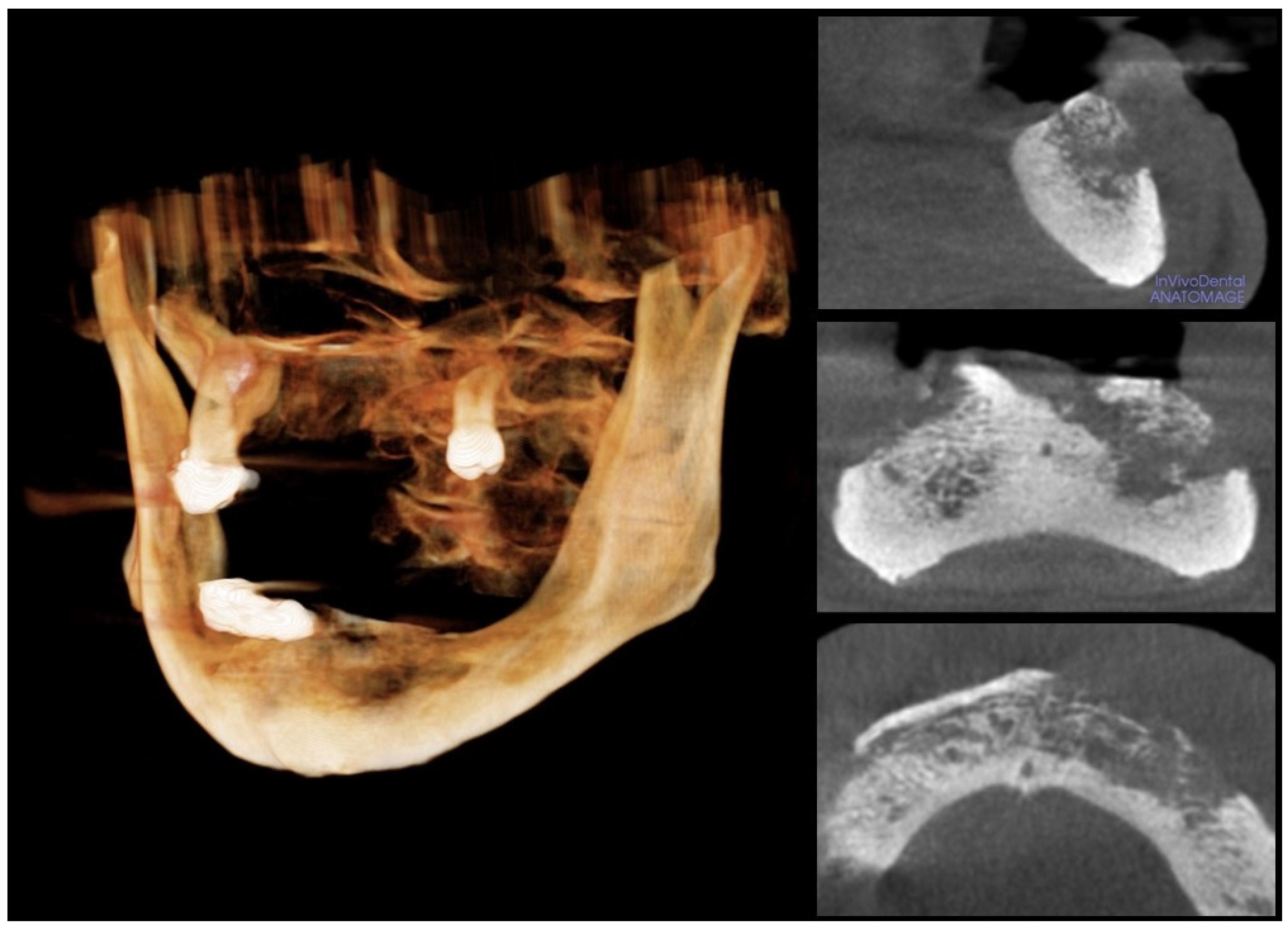 Exposed Necrotic Bone in a Head and Neck Cancer Patient: Report of a ...