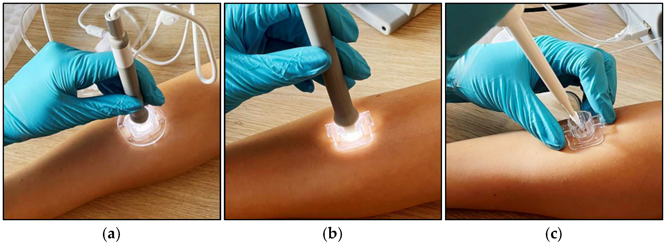 Use of a Silicon Microneedle Chip-Based Device for the Extraction and ...