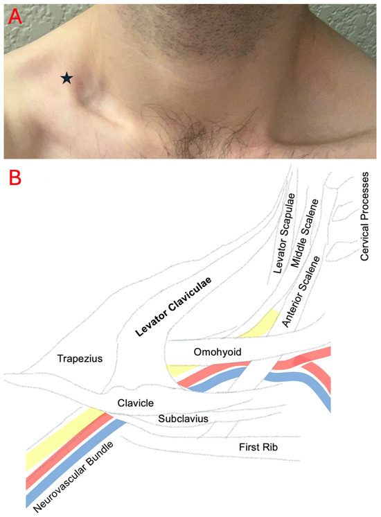 Identification of a Musculus Levator Claviculae on Physical Exam: A ...
