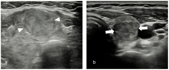 Comparison of K-TIRADS, EU-TIRADS and ACR-TIRADS Guidelines for ...