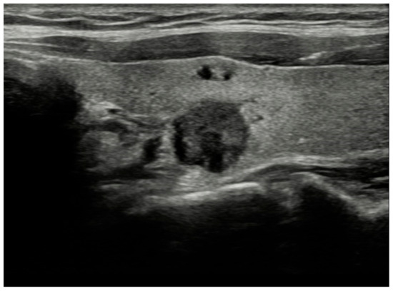 Comparison of K-TIRADS, EU-TIRADS and ACR-TIRADS Guidelines for ...